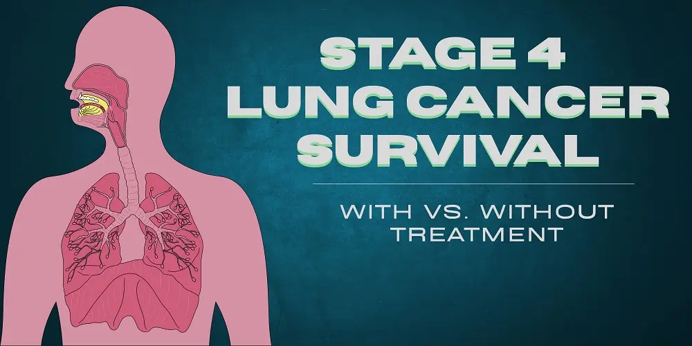 Stage 4 Lung Cancer Survival: With vs. Without Treatment | HOSPIDIO
