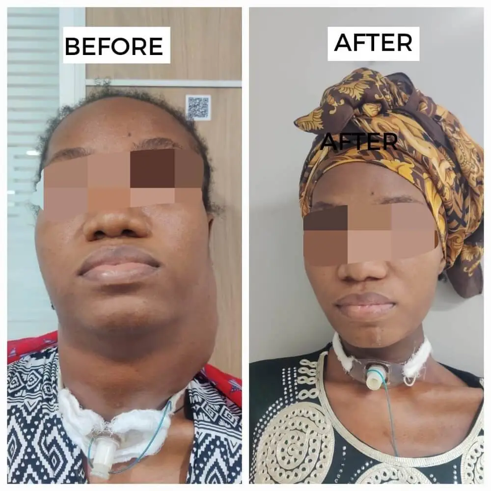 Nigerian Woman's Neck Tumor Surgery: A Landmark Procedure | HOSPIDIO